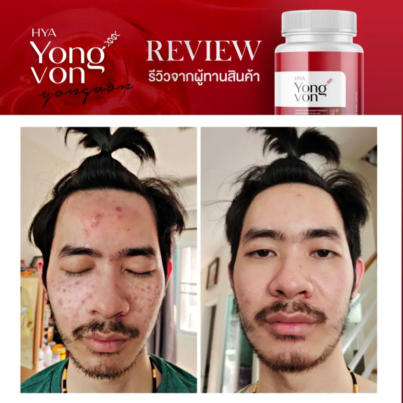 Yong Von HYA Gluta - Thaimegastore