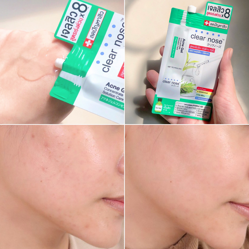 Clear Nose Acne Gel Concentrate Solution - Thaimegastore